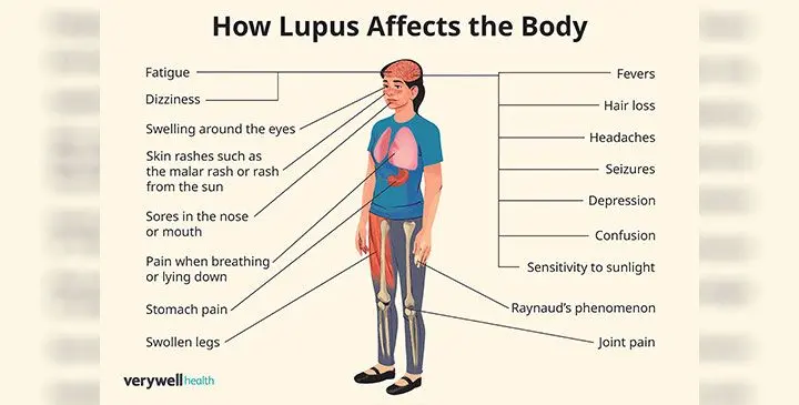 Shine A Light: Lupus a Chronic Disease You Must Be Aware Of | Fiji Sun